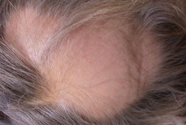 Types of Alopecia Areata | Alopecia Areata Hair Loss Treatment - SRS ...