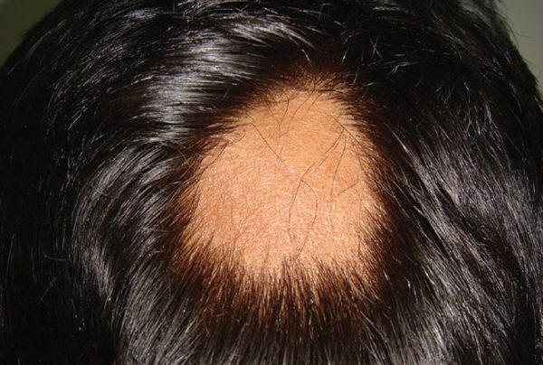 Types of Alopecia Areata | Alopecia Areata Hair Loss Treatment - SRS ...
